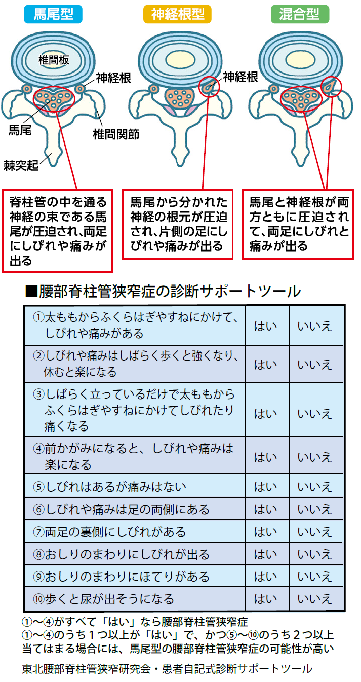 排尿障害にもつながる『腰部脊柱管狭窄症』